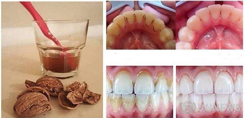1가지 간단한 치료법으로 치석을 없애는 방법. | UNnews 유엔뉴스 유엔신문
